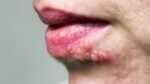 Boutons autour de la bouche : causes et solutions